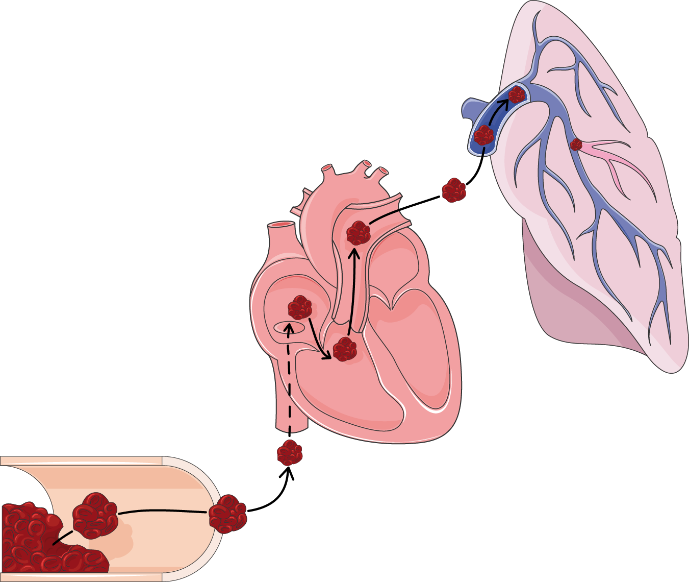 Lungenarterienembolie (LAE) | Rettungsdienst FactSheets